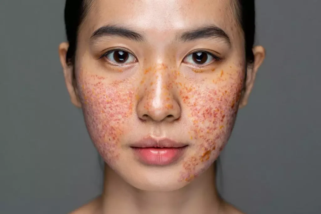 Skin Barrier Rusak: 5 Penyebab Dan Cara Memperbaikinya
